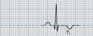 Come leggere l'ECG: un metodo per imparare l'elettrocardiogramma