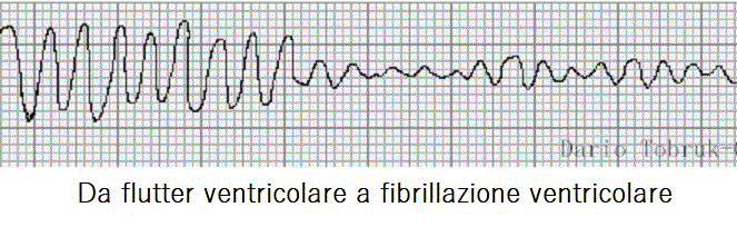 Le principali aritmie cardiache al tracciato Ecg spiegate in modo semplice