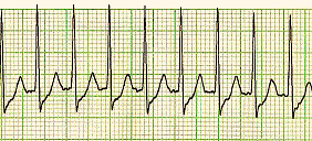 Le principali aritmie cardiache al tracciato Ecg spiegate in modo semplice