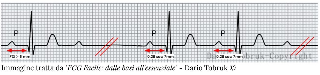 Blocco atrioventricolare (BAV): come riconoscerlo dall'elettrocardiogramma
