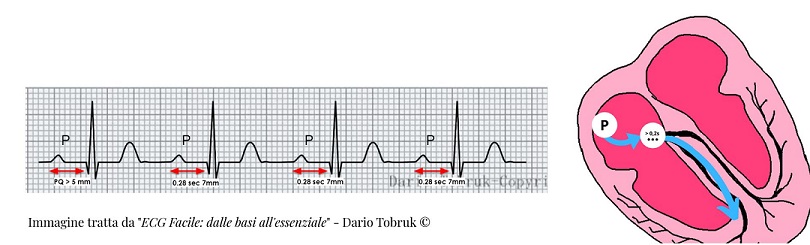Blocco atrioventricolare (BAV): come riconoscerlo dall'elettrocardiogramma