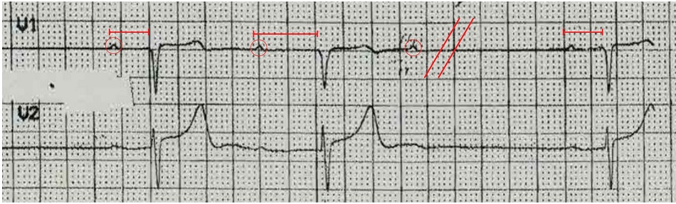 Blocco atrioventricolare (BAV): come riconoscerlo dall'elettrocardiogramma