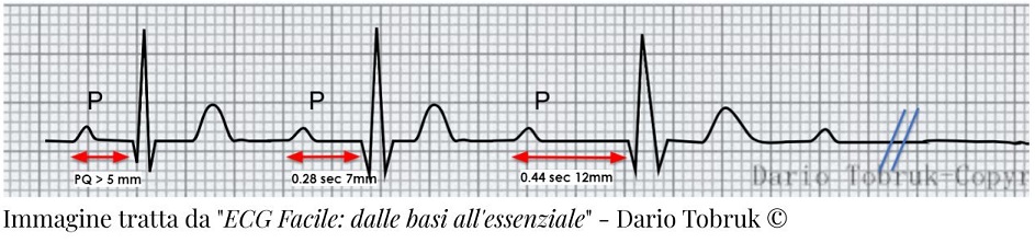 Blocco atrioventricolare (BAV): come riconoscerlo dall'elettrocardiogramma