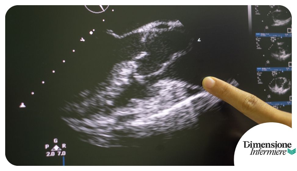 Valutazione ecocardiografica del Wall Motion Score Index