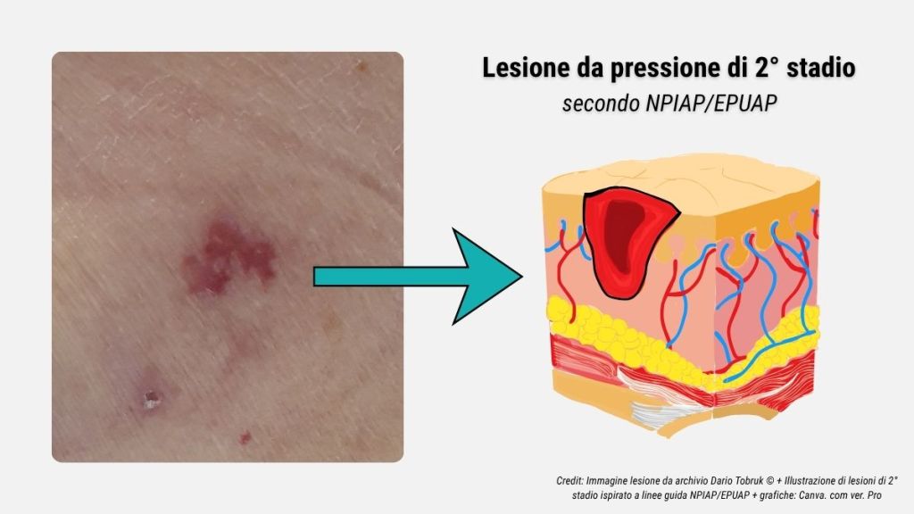 Stadiazione delle lesioni da pressione secondo NPIAP-EPUAP