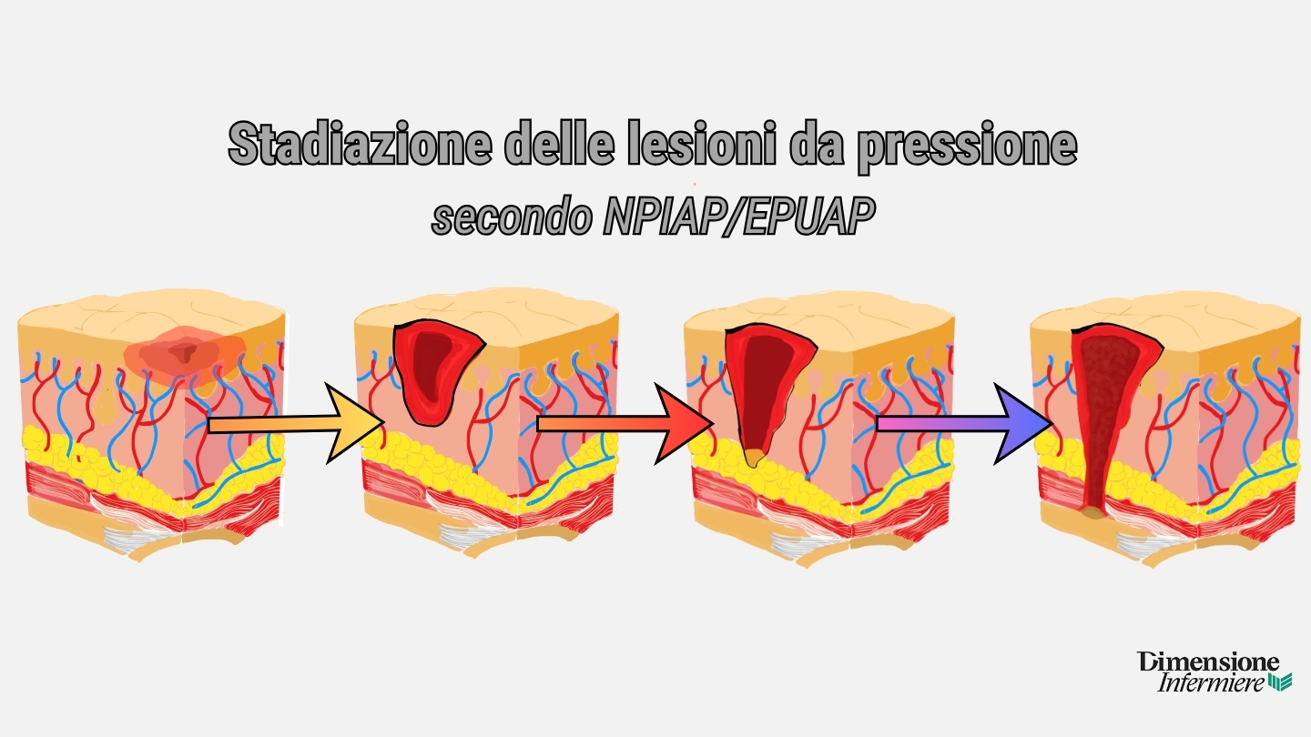 Stadiazione delle lesioni da pressione secondo NPIAP-EPUAP