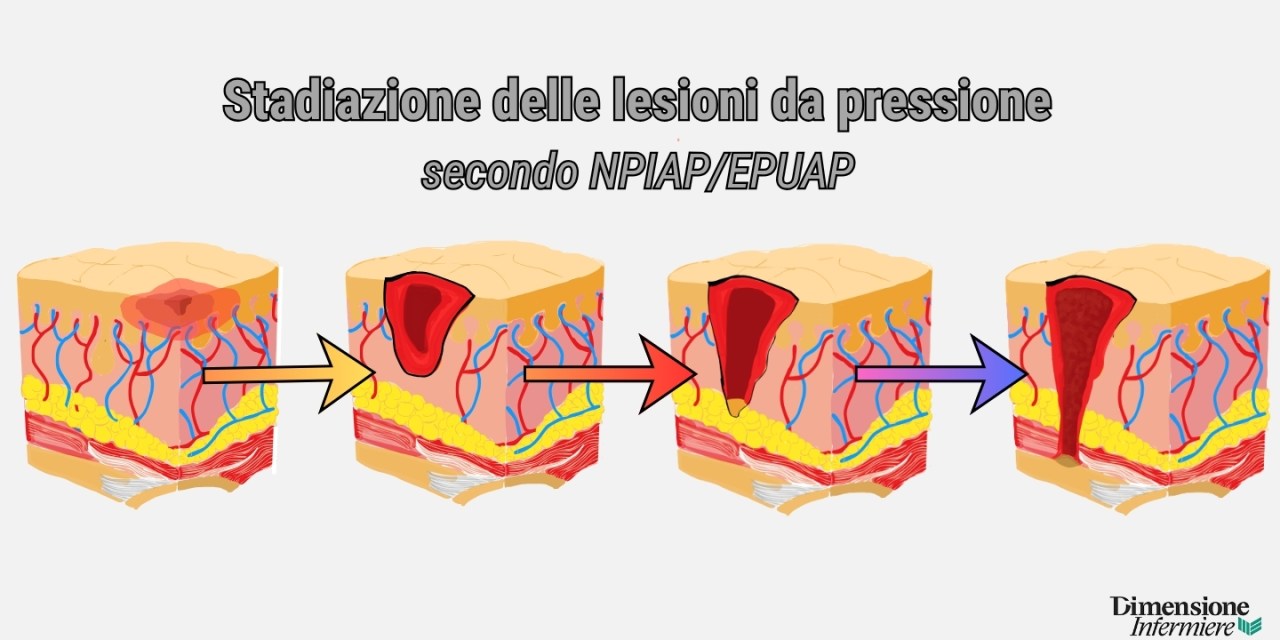 Nutrizione enterale tramite PEG e cura della cute peristomale